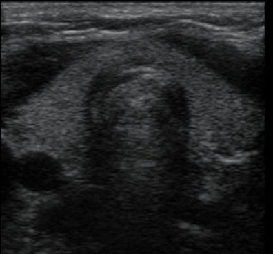 Tiroiditis subaguda, dolor cervical y tirotoxicosis despues de infeccioes