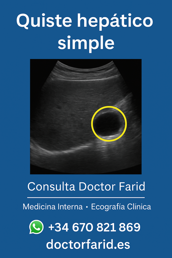 Quiste hepático simple: hallazgo frecuente en la ecografía